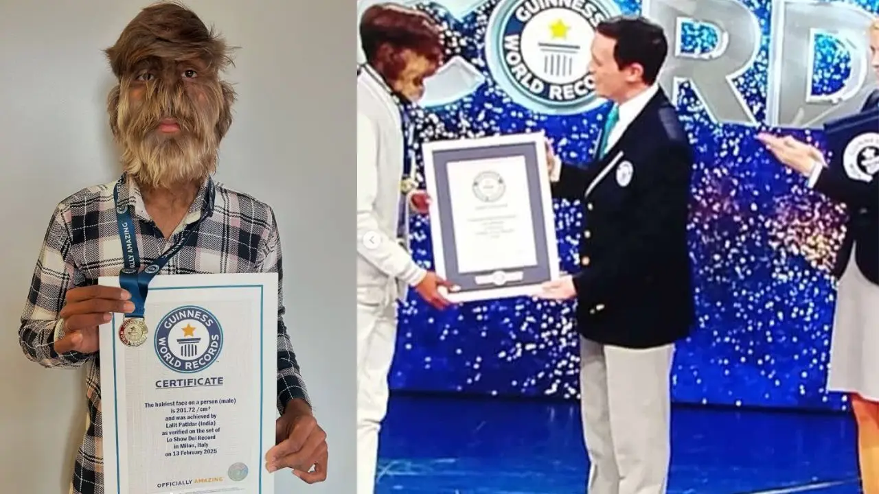 ‘Werewolf Syndrome’: Indian boy secures Guinness World Record for ...