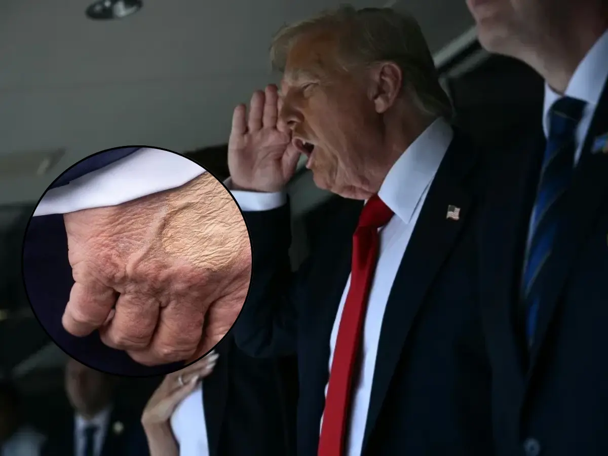 'Swollen fingers, bruised hand, marks on ankles': Trump's photos from ...